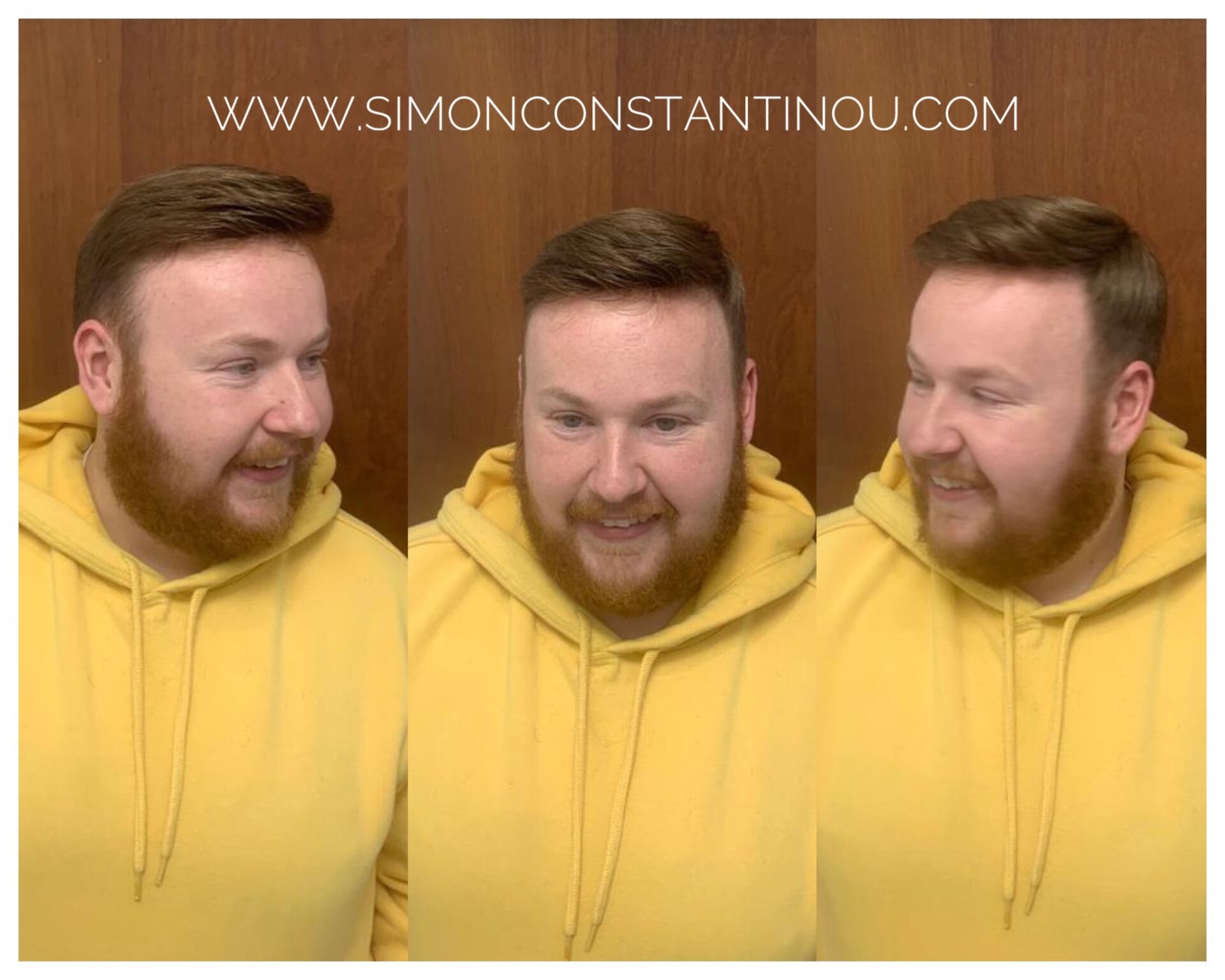 Men’s Hair Replacement Systems |Hair Loss Solutions at Simon ...