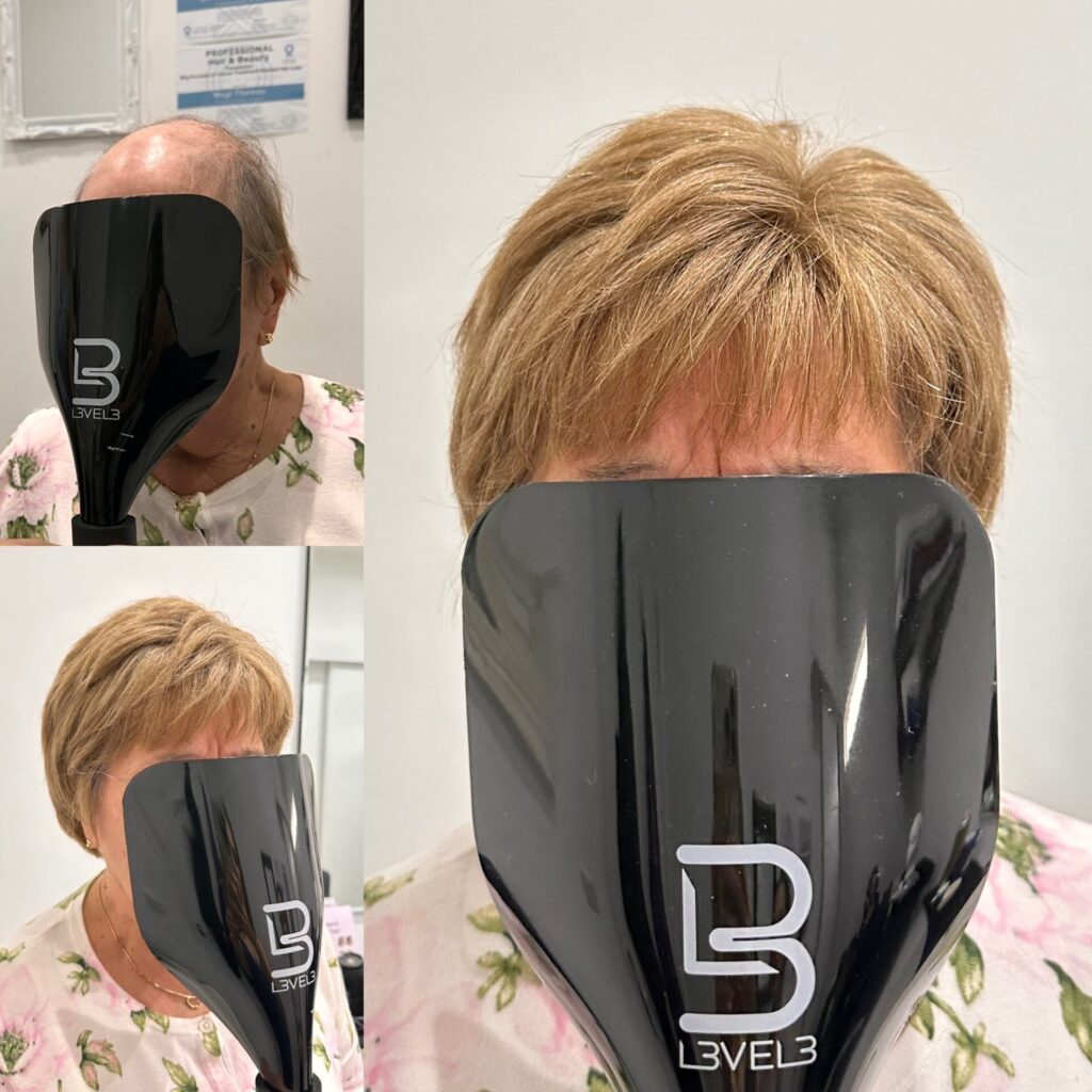 Hair Loss Solutions at Simon Constantinou